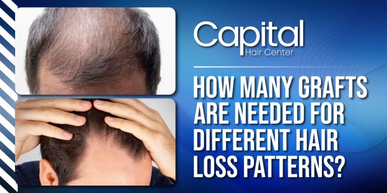 How many grafts are needed for different hair loss patterns?