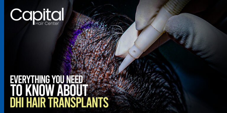 Everything You Need to Know About DHI Hair Transplants